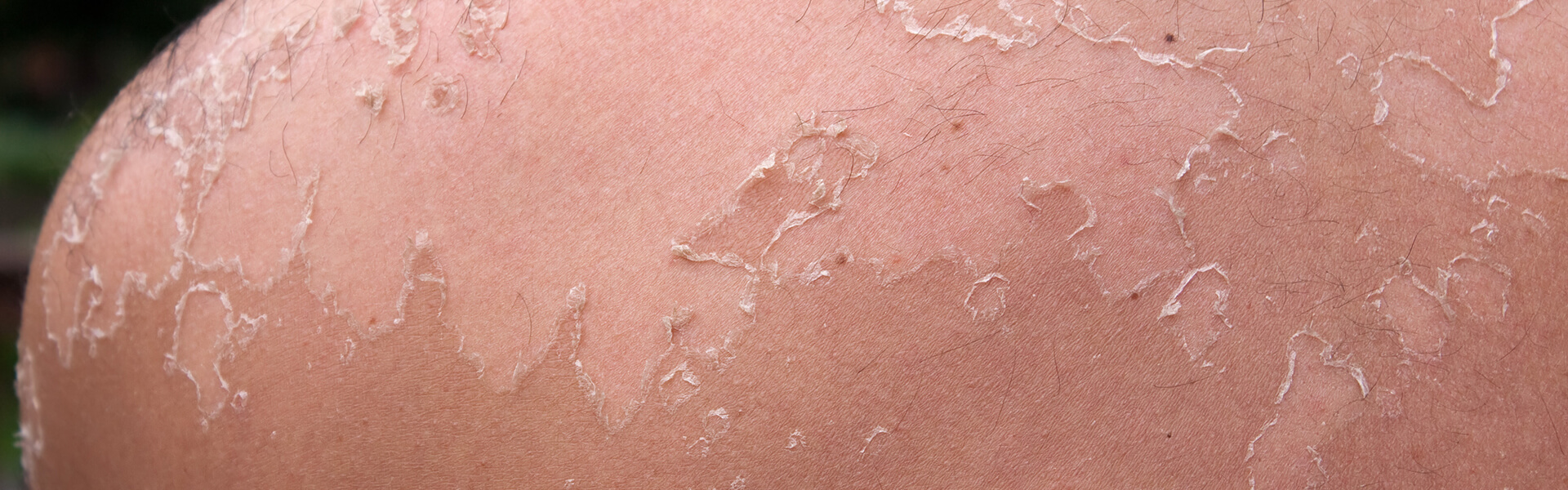 Anti Aging Treatments Lafayette LA | Dermatology Center of Acadiana